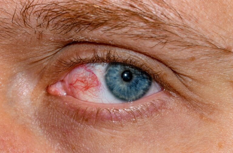 What Causes Broken Blood Vessels in the Eye?